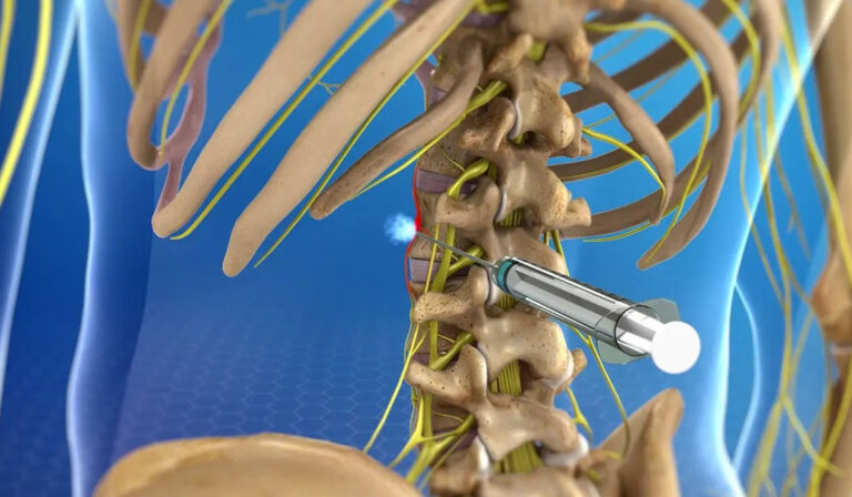 Sympathetic Nerve Block Treatment in Ahmedabad | NEXUS Advanced Pain ...